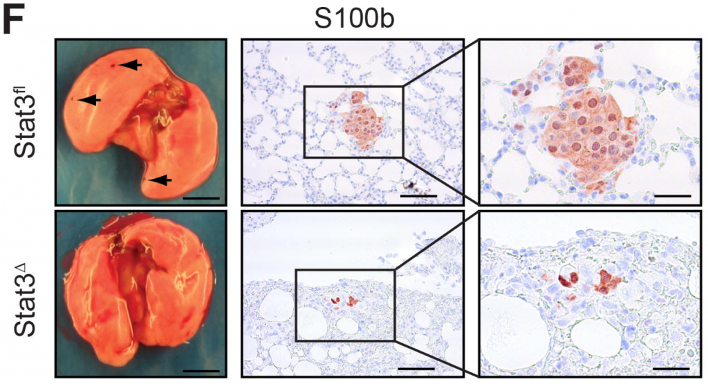 STAT3 promotes melanoma metastasis by CEBP-induced repression of the ...