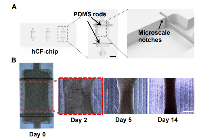 Human cardiac fibrosis-on-a-chip model recapitulates disease hallmarks ...