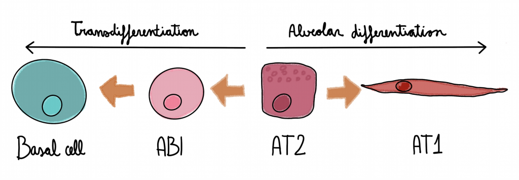 Human alveolar Type 2 epithelium transdifferentiates into metaplastic ...